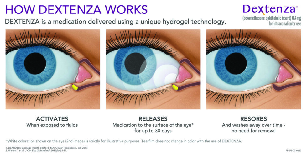 New Dextenza Reduces the Drop Regimen after Cataract Surgery